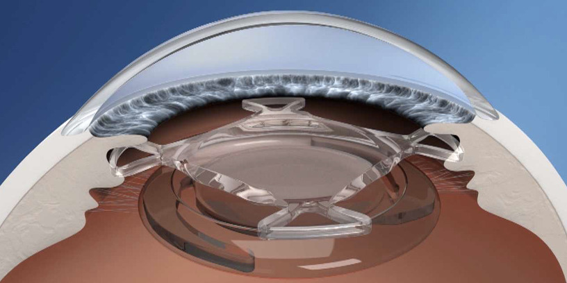 AddOn IOL（アドオン眼内レンズ）- 白内障手術後の追加挿入レンズ｜東京都中野区 ふくおか眼科クリニック 中野