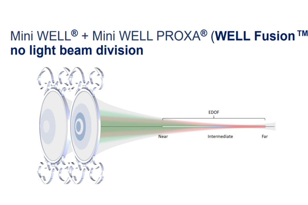 ミニウェル,ミニウェル プロクサ（ウェルフュージョン） - 新コンセプトの多焦点眼内レンズ｜ふくおか眼科クリニック 中野